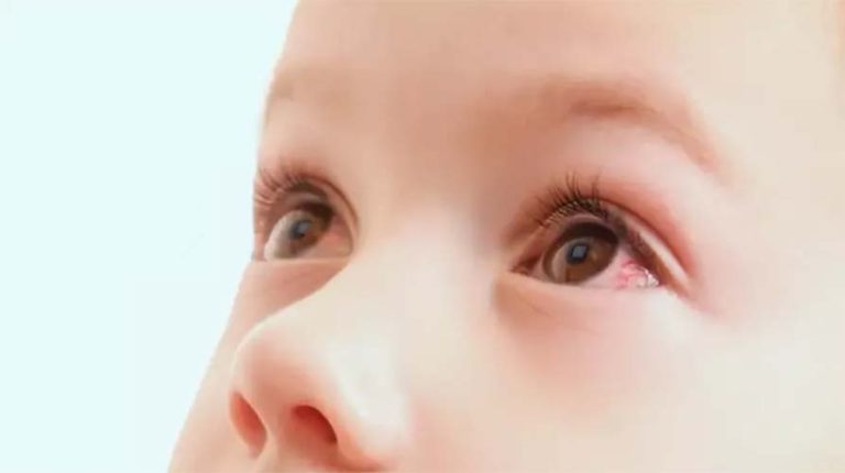 Mata Merah pada Anak: Penyebab dan Cara Mengatasinya