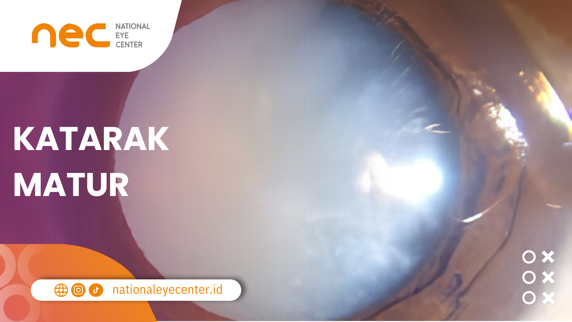 Penjelasan Tentang 4 Tanda Stadium Katarak Senilis